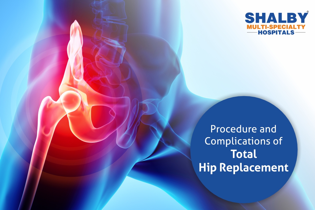 Procedure and Complications of Total Hip Replacement | Shalby