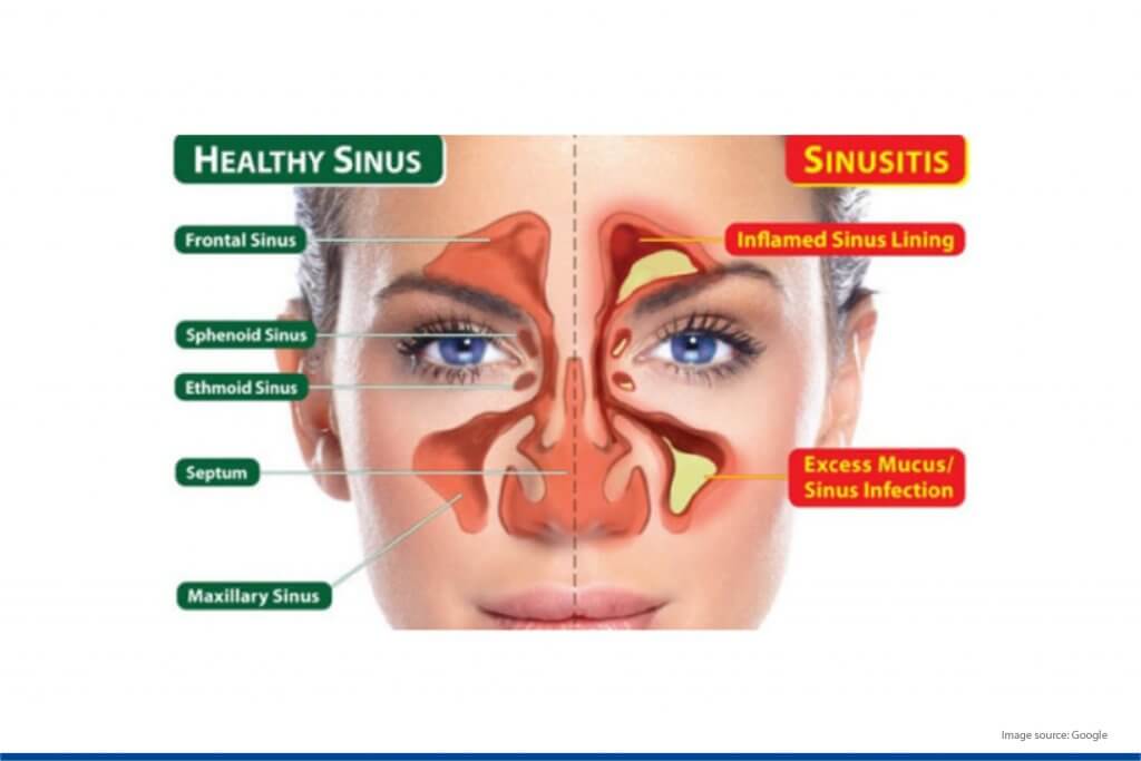 Things you need to know about Sinusitis Surgery | Shalby Hospitals